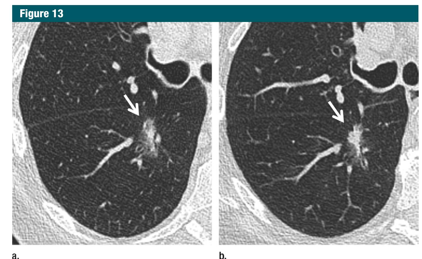 (PDF) Guidelines for Management of Incidental Pulmonary Nodules ...