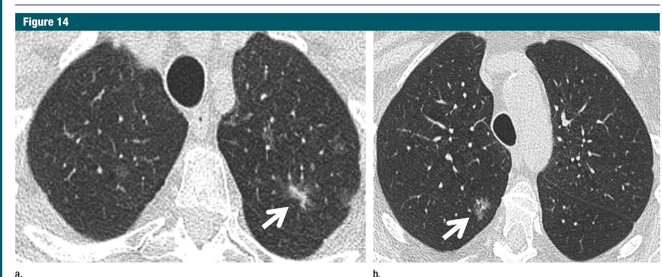 (PDF) Guidelines for Management of Incidental Pulmonary Nodules ...