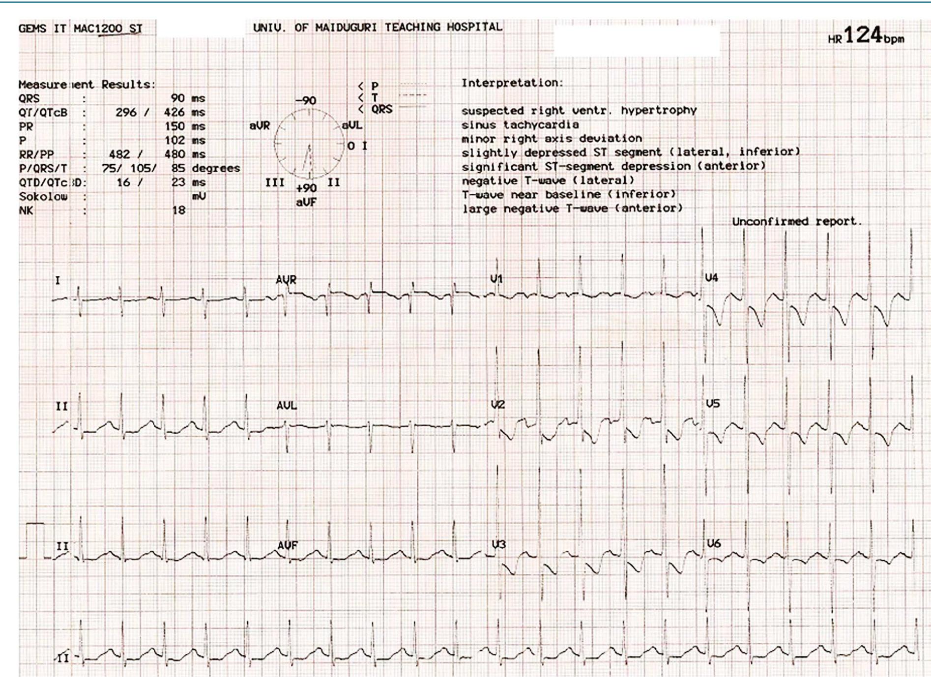 Ecg of a victim of scd from pulmonary hypertension, showing