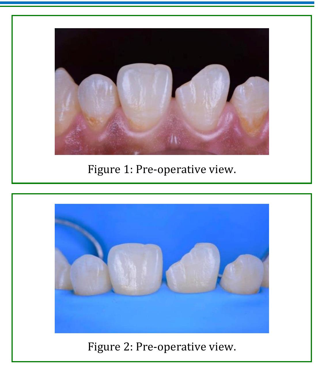 The first stage of the restorative procedure was the