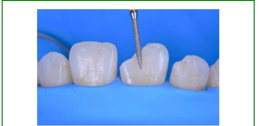 Preparation of the tooth structure.