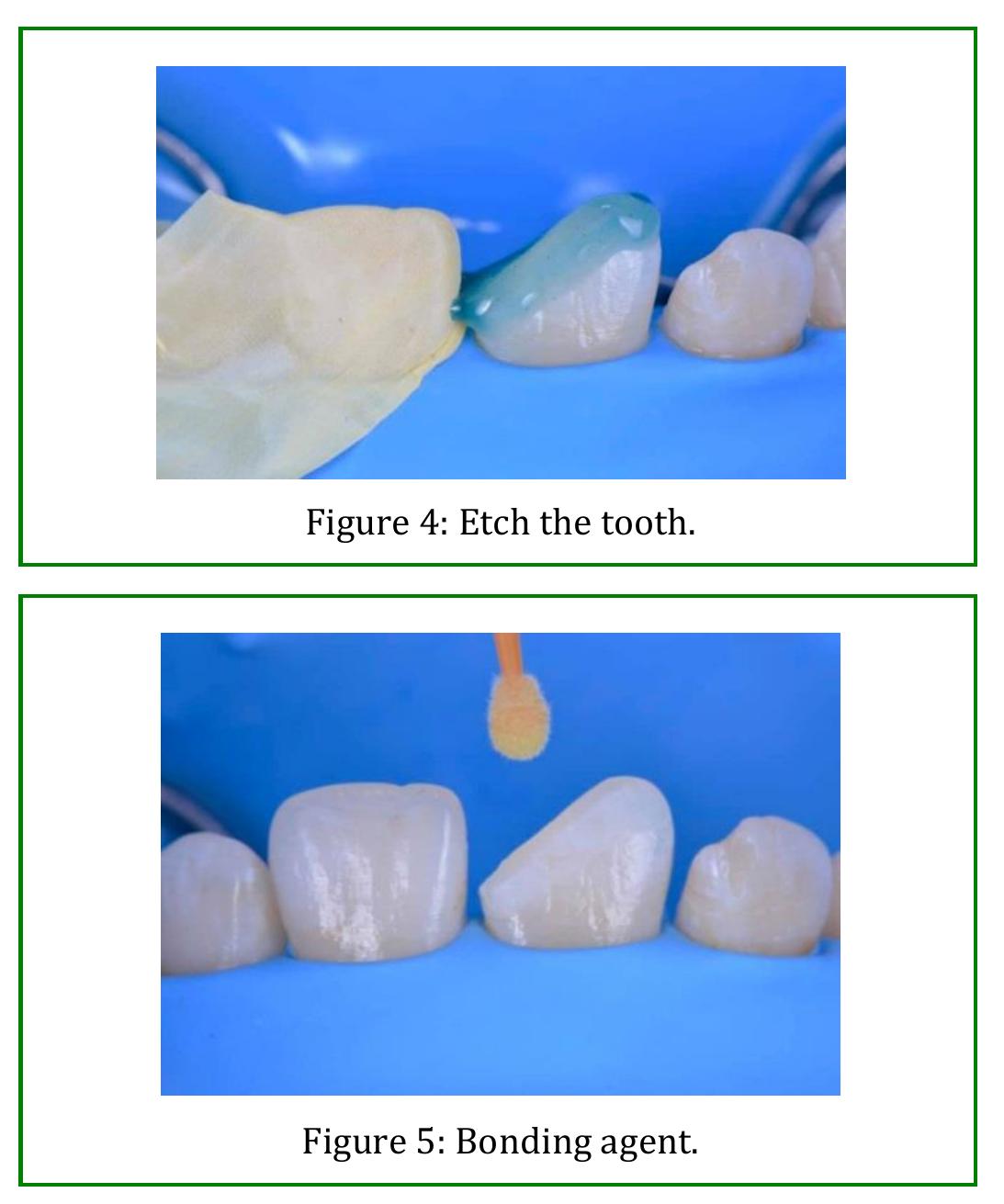 Two bottle adhesive system (was applied on enamel and