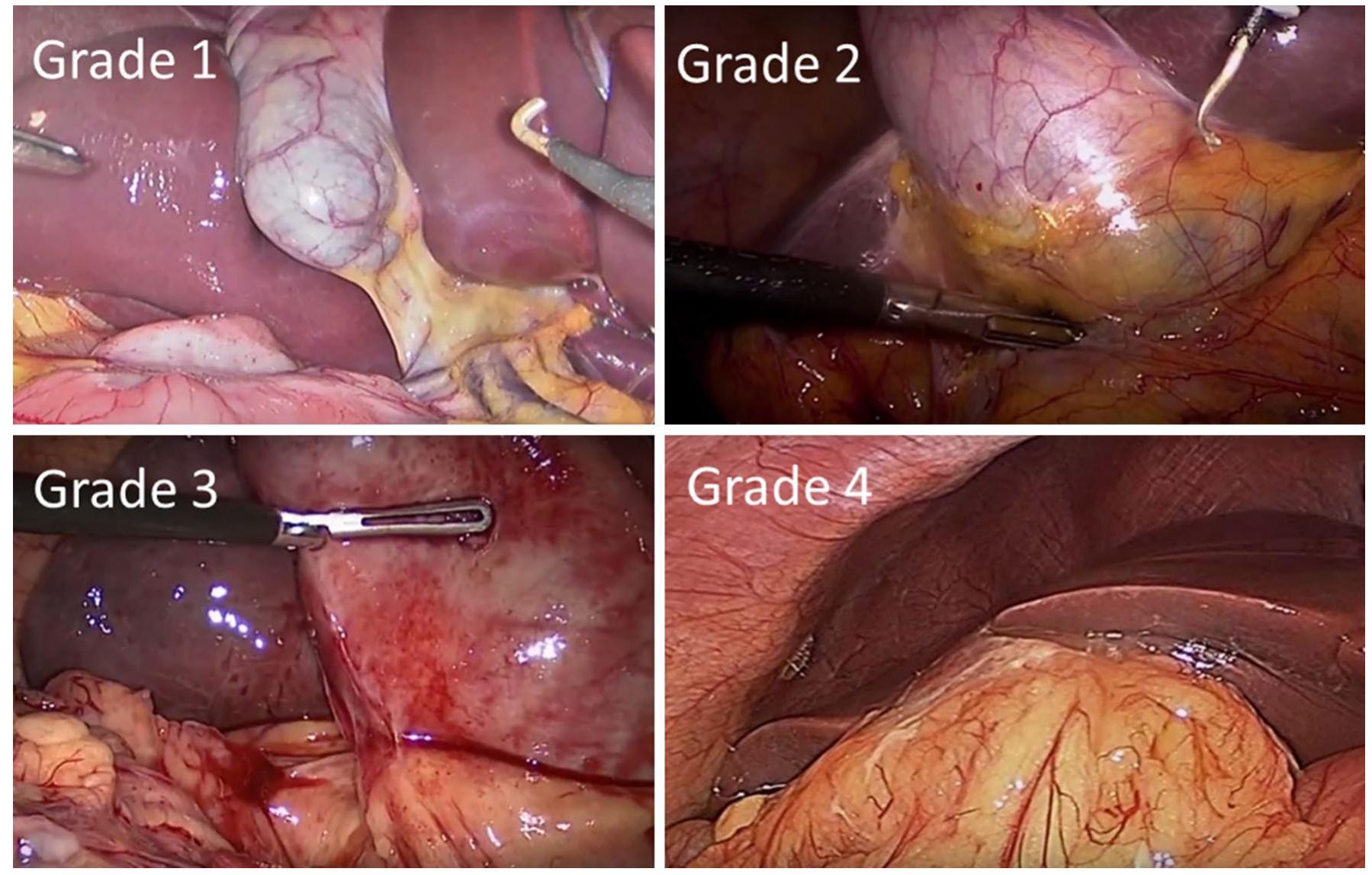 Laparoscopic photos of each nassar operative difficulty