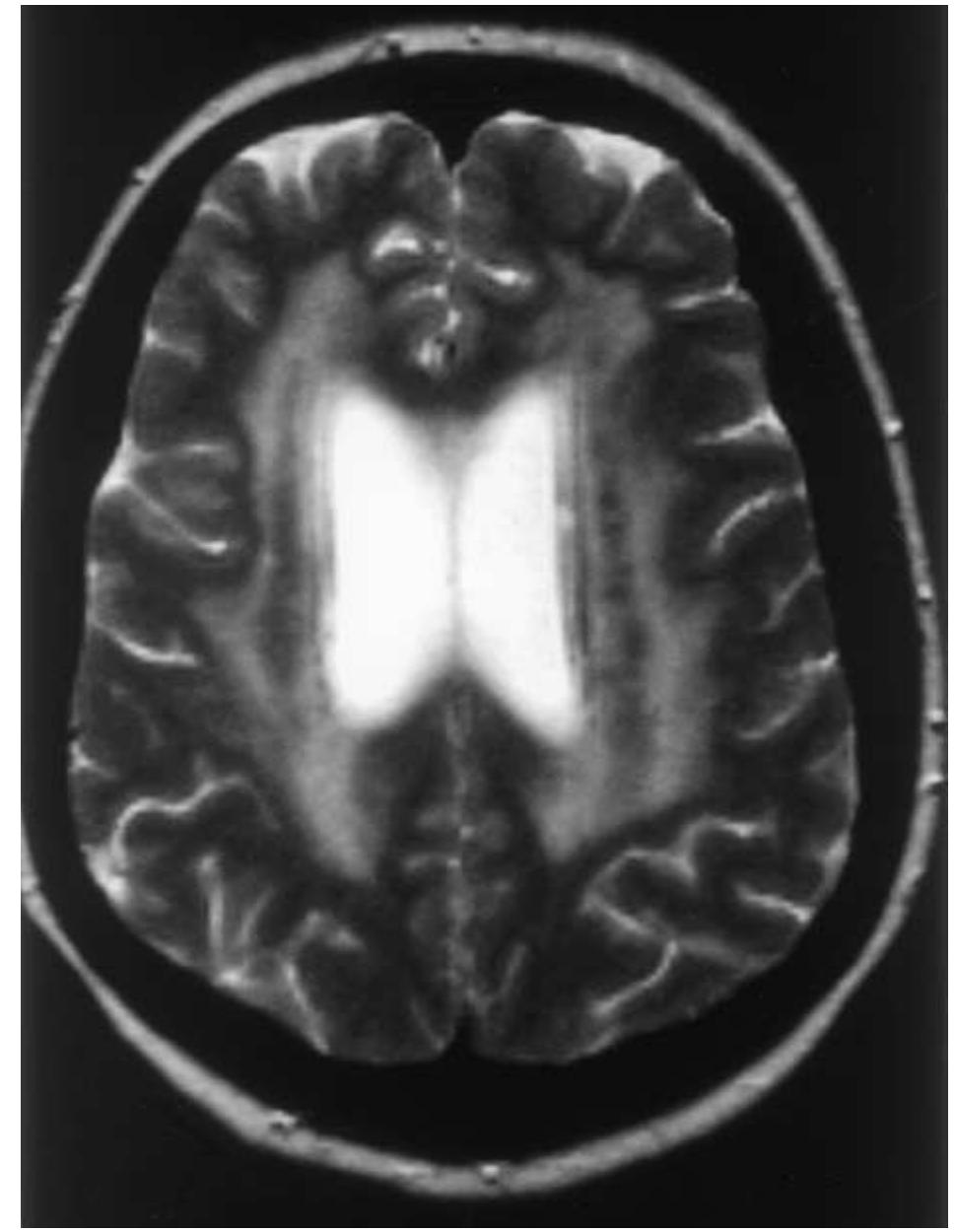 T2-weighted axial mri brain scan. large areas of increased