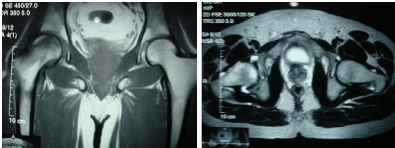 4c, 4d - mri showing on femoral head right side