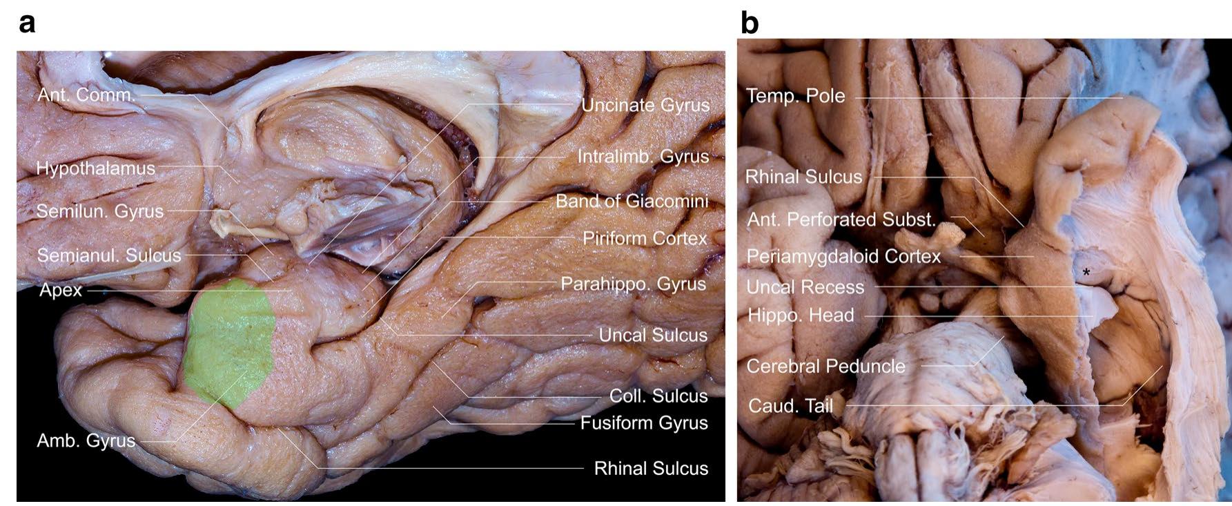 Located anteriorly to the amygdaloid body. the uncus
