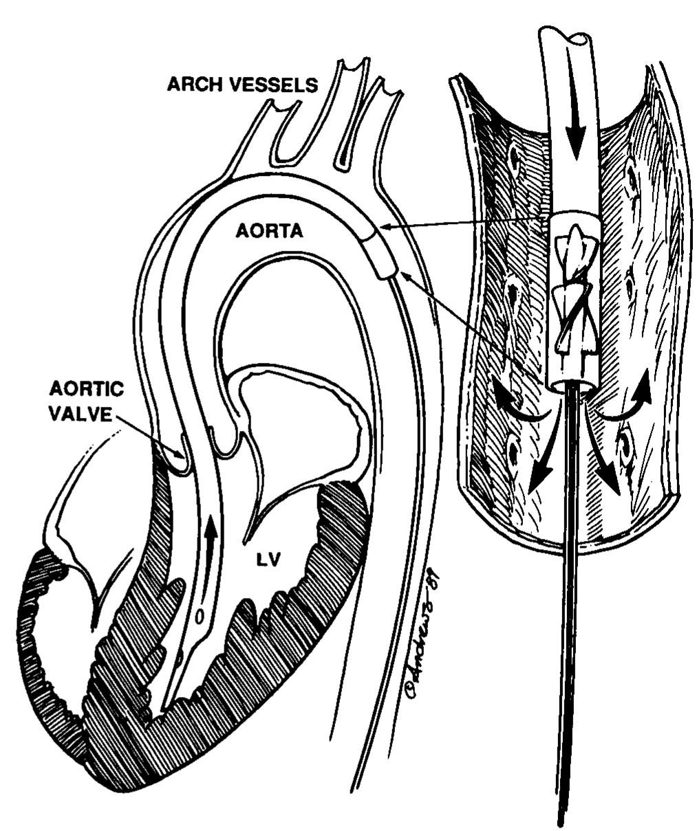 Position of hemopump in left ventricle and aortic arch, with