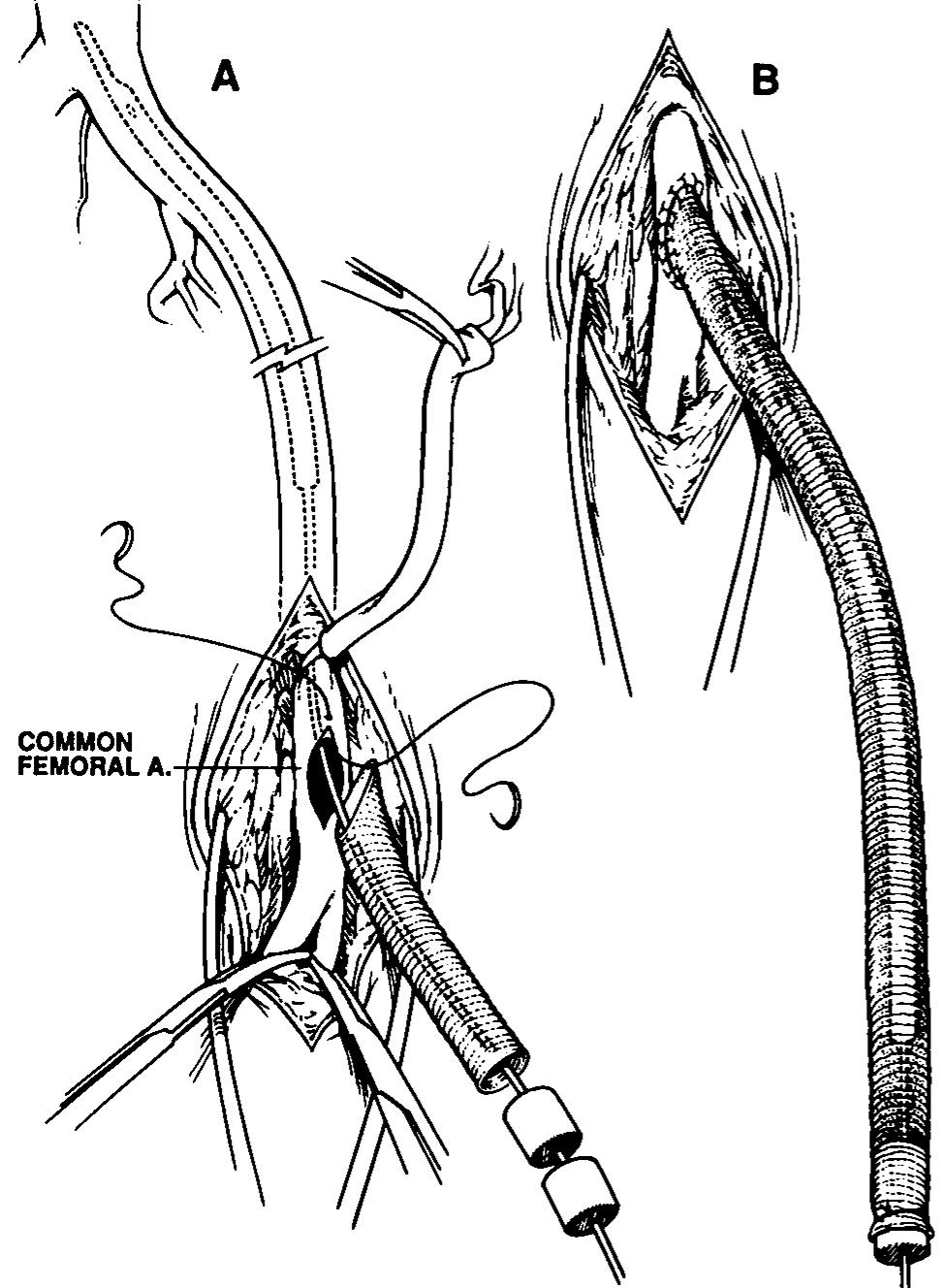 Two different techniques for femoral insertion. (a) direct