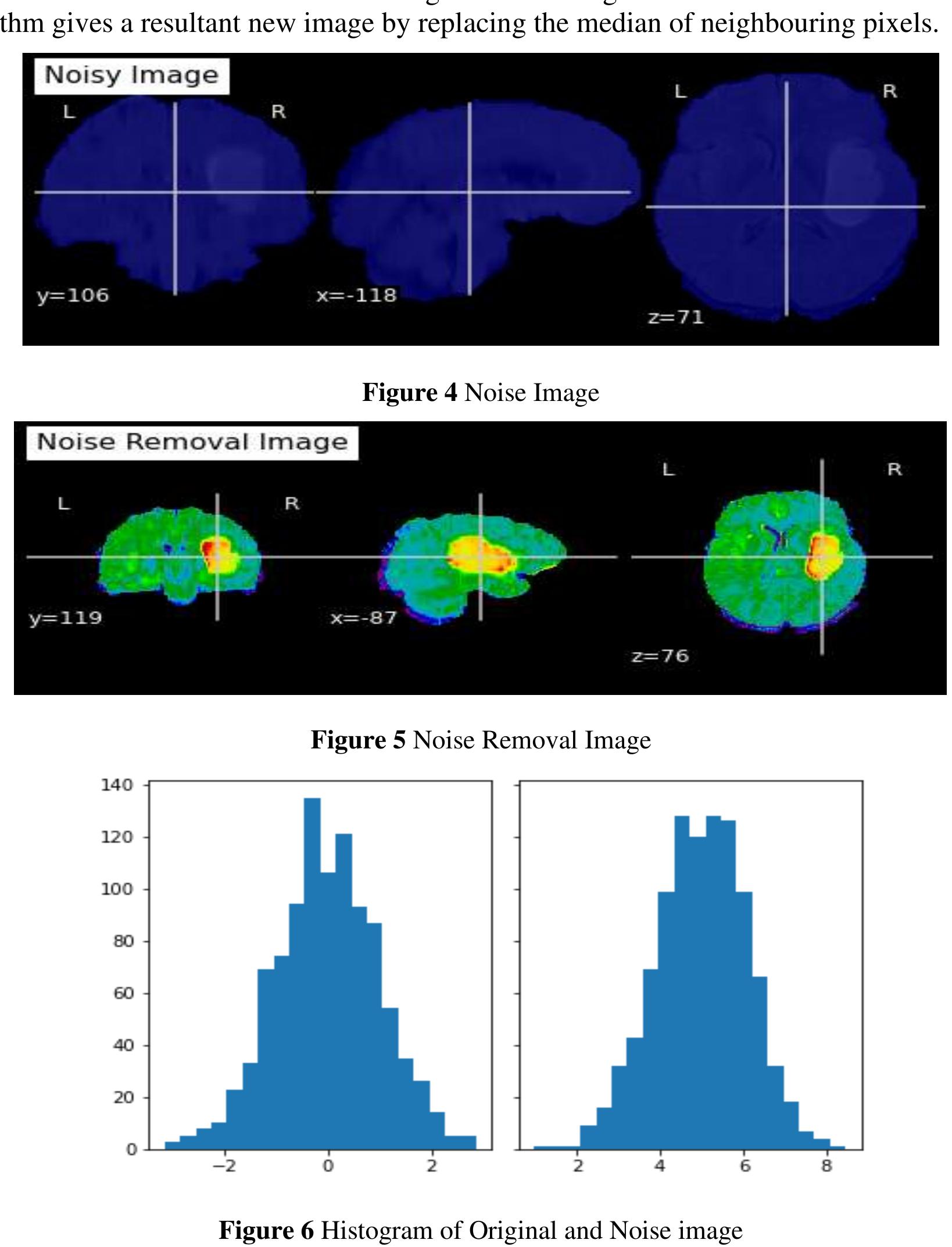 Figure 3 - BRAIN TUMOR CLASSIFICATION IN 3D-MRI USING