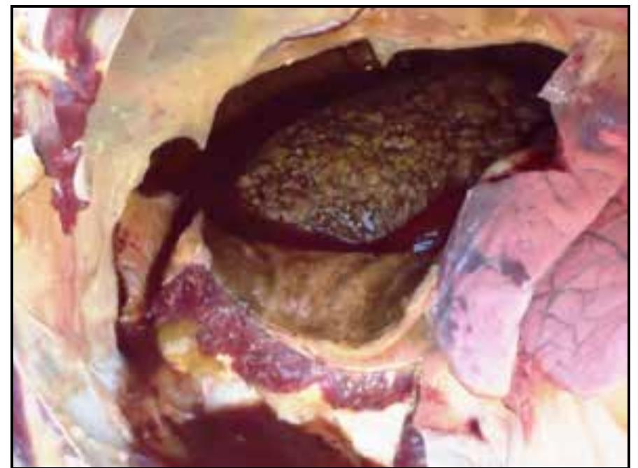 Traumatic reticulopericarditis: suppuration of pericar- dium