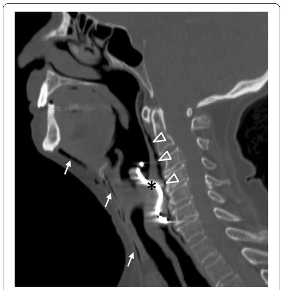 77-year-old patient with prolonged dysphagia. sagittal