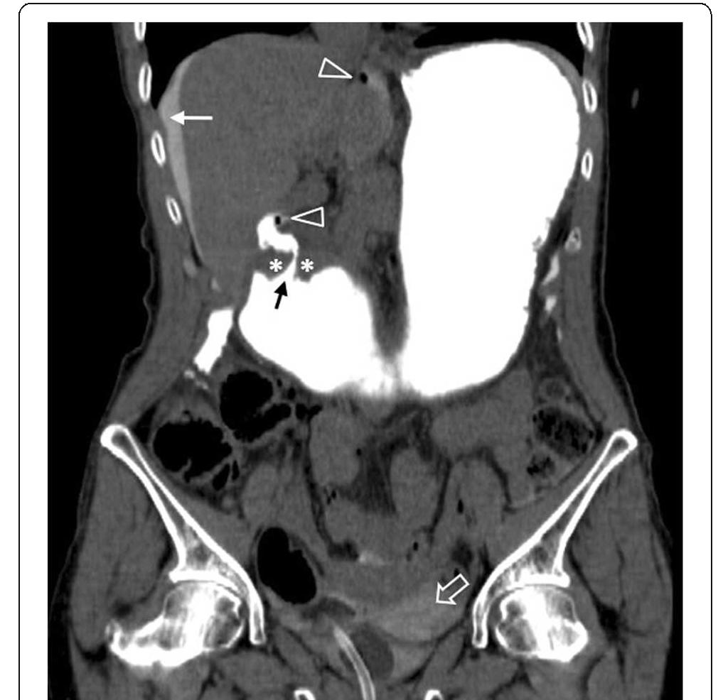 65-year-old patient with perforated duodenal ulcer. coronal