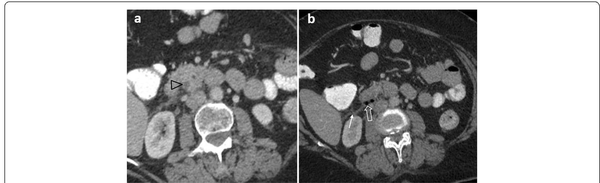 75-year-old patient with duodenal perforation post-ercp. a,