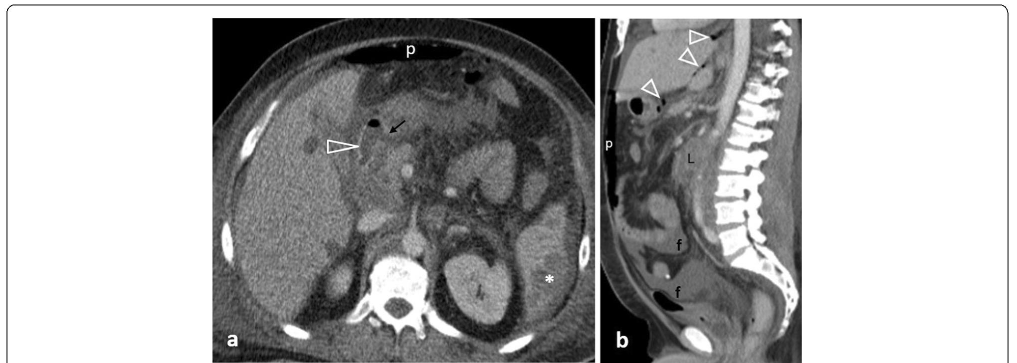 62-year-old patient with perforating gastric carcinoma. a