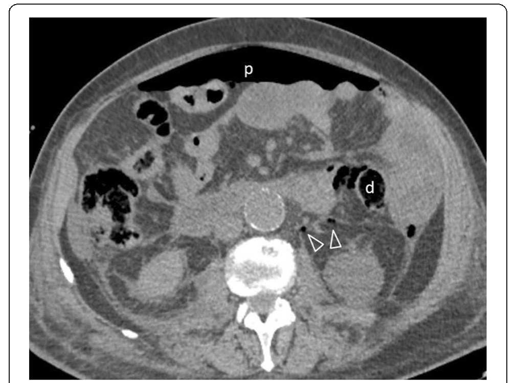 73-year-old patient with perforated diverticulitis. gas
