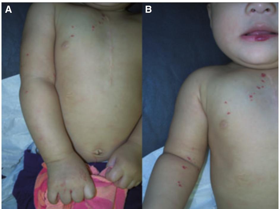 Figure 5 - from PHACE without Face? Infantile Hemangiomas of