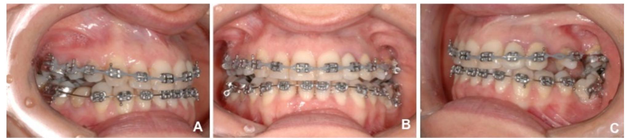 (7). after alignment and leveling with 0.019" x 0.025" ss
