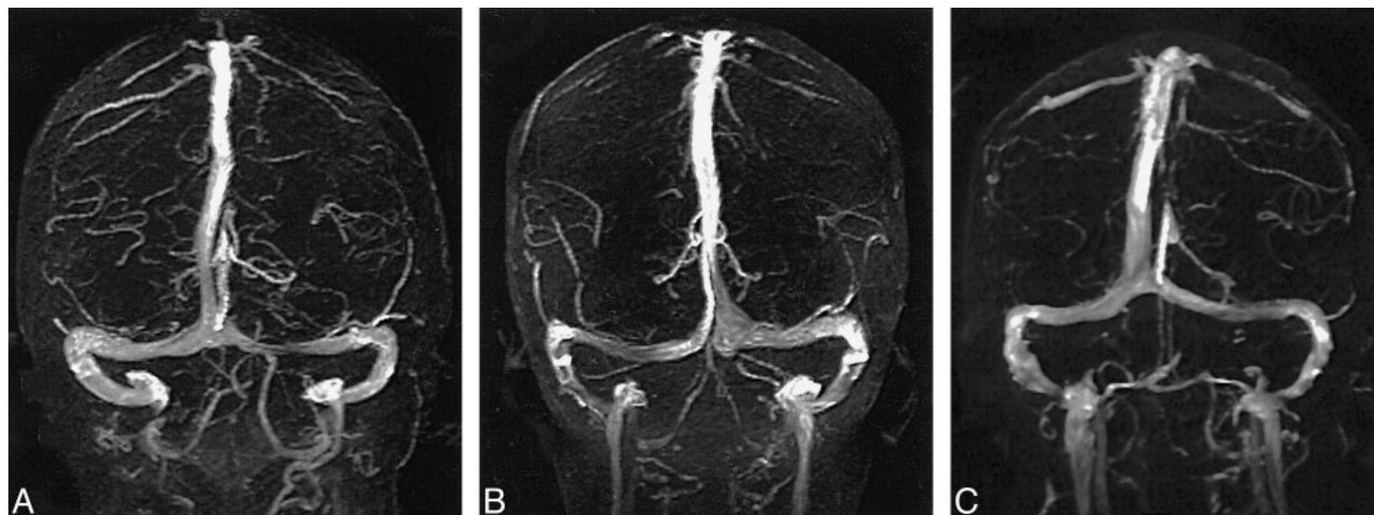 Figure 2 - Cerebral MR Venography: Normal Anatomy and