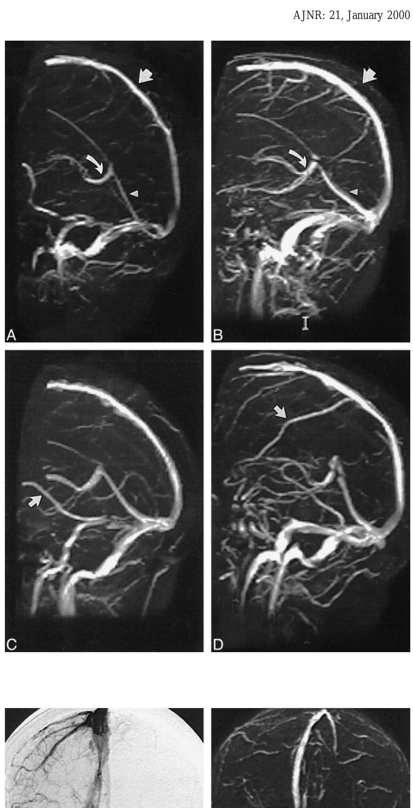 Figure 3 - Cerebral MR Venography: Normal Anatomy and