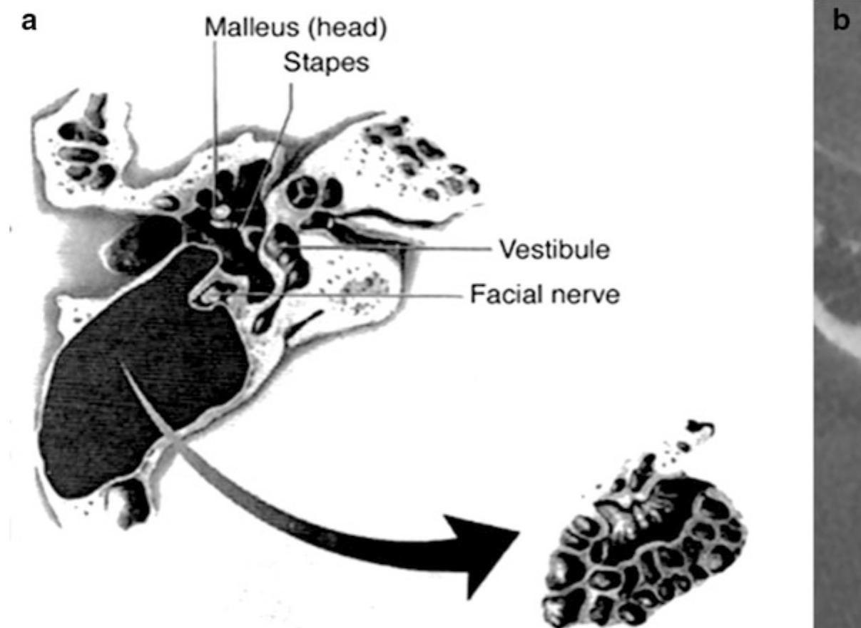 Figure 3 - Post-operative Temporal Bone Imaging