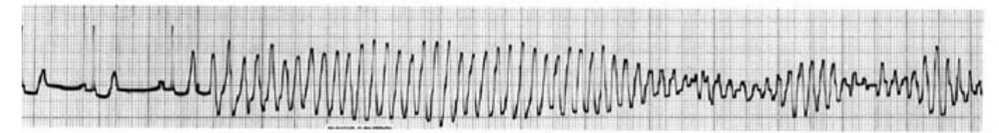Polymorphic ventricular tachycardia emerging from normal