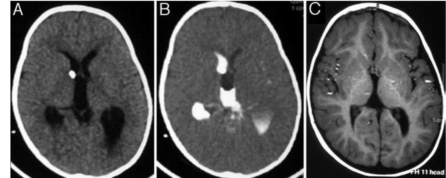 Case 1. a: axial ct scan following evd placement showing