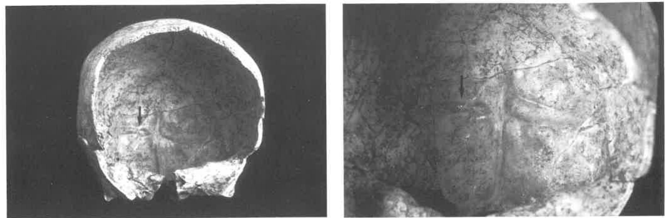 S. sa.b views of the posterior fossa of the cranium showing