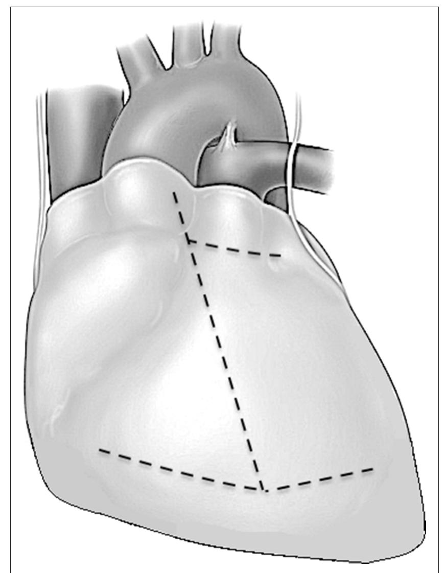 Schematic drawing of pericardial incision lines. a total of
