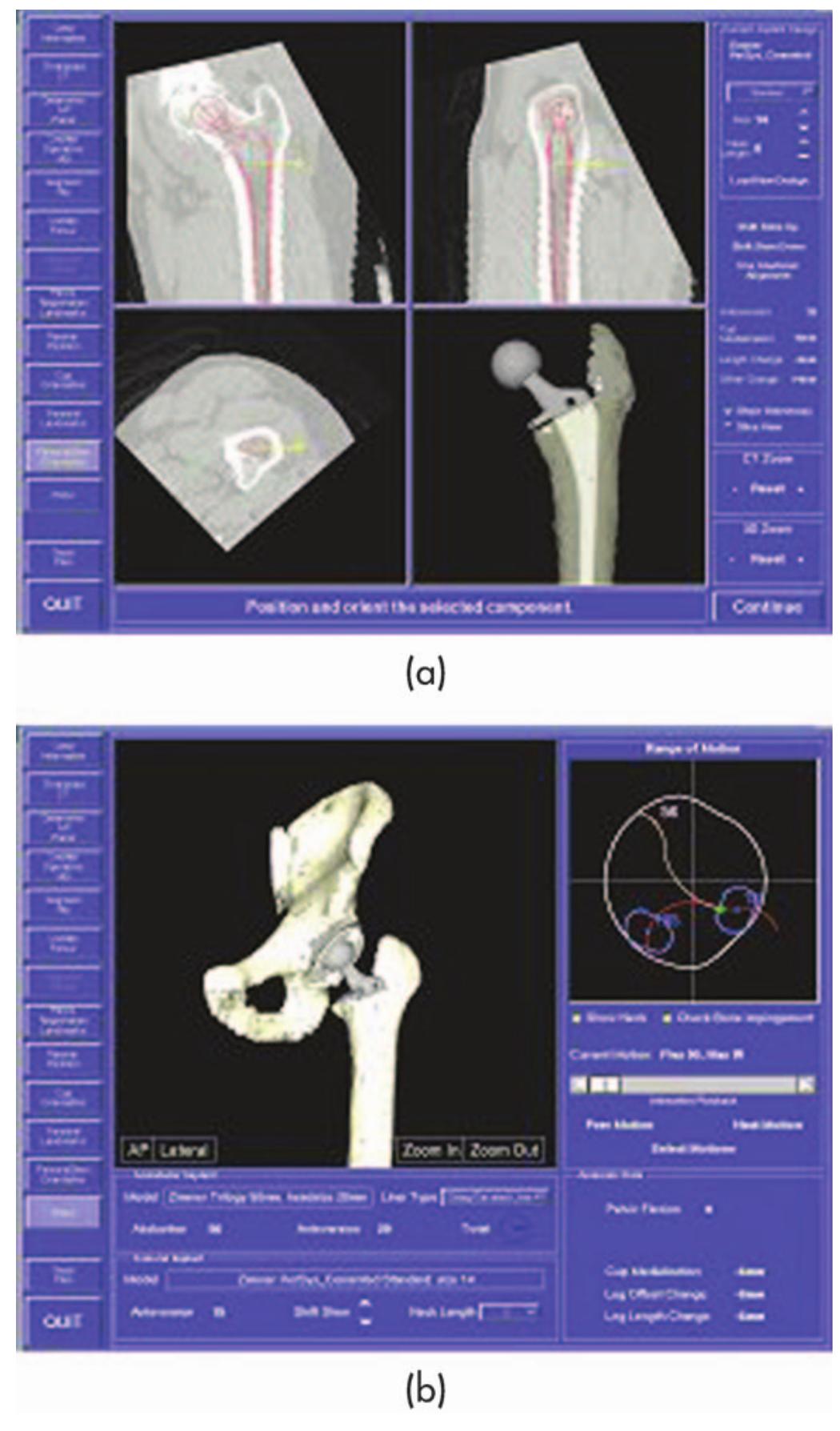Screenshots of the hipnav preoperative planner; a) implant
