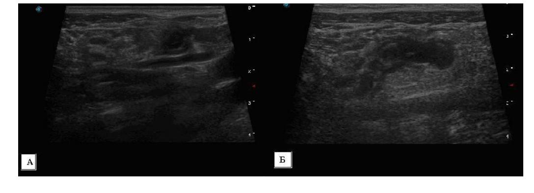 Us. a—phlegmonous appendicitis: target-sign,