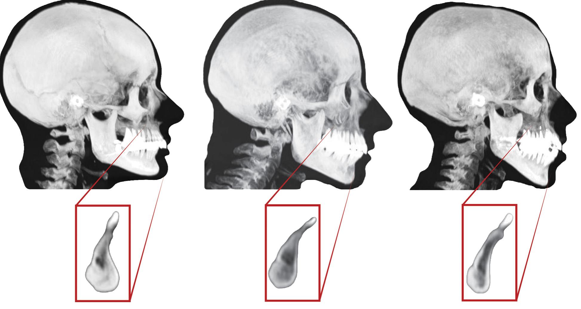 Examples of facial types and their respective chin and