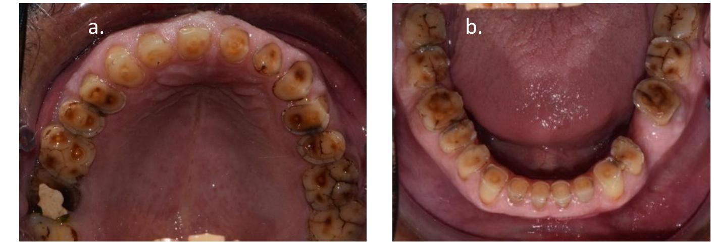 Pre-operative occlusal view: a. maxillary, b. mandibular ews