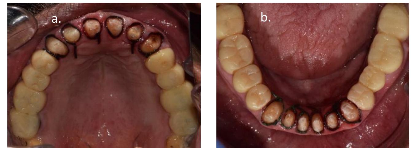 Gingival retraction of anterior teeth: a. maxillary, b.