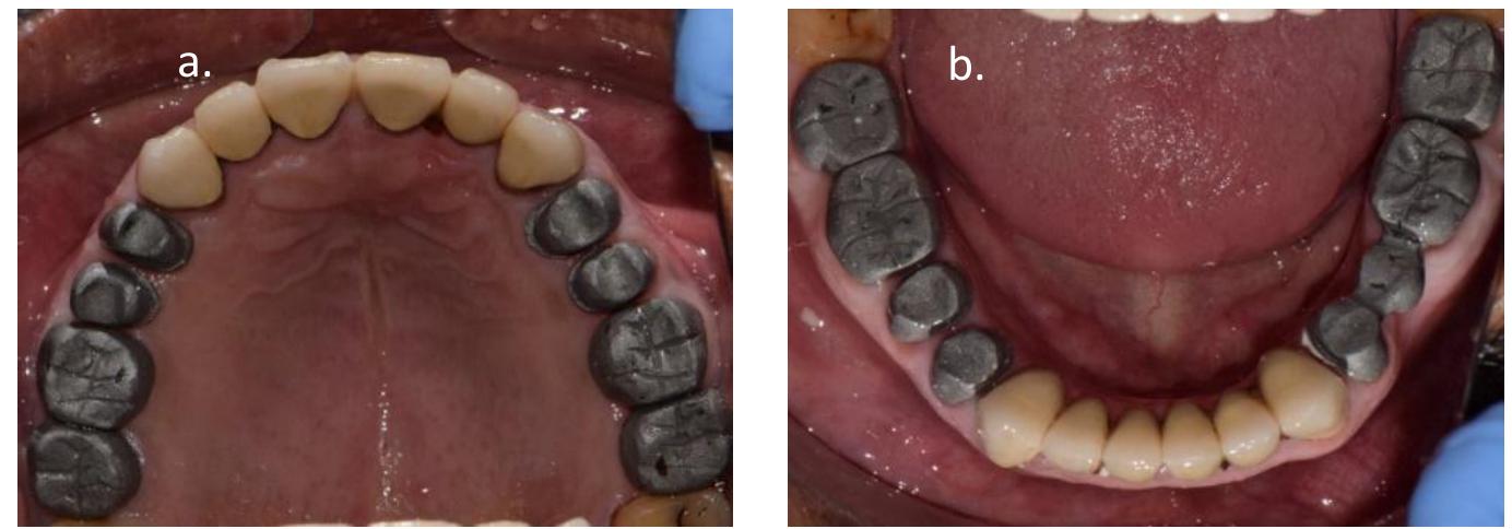 The casts were mounted using a facebow record, followed by
