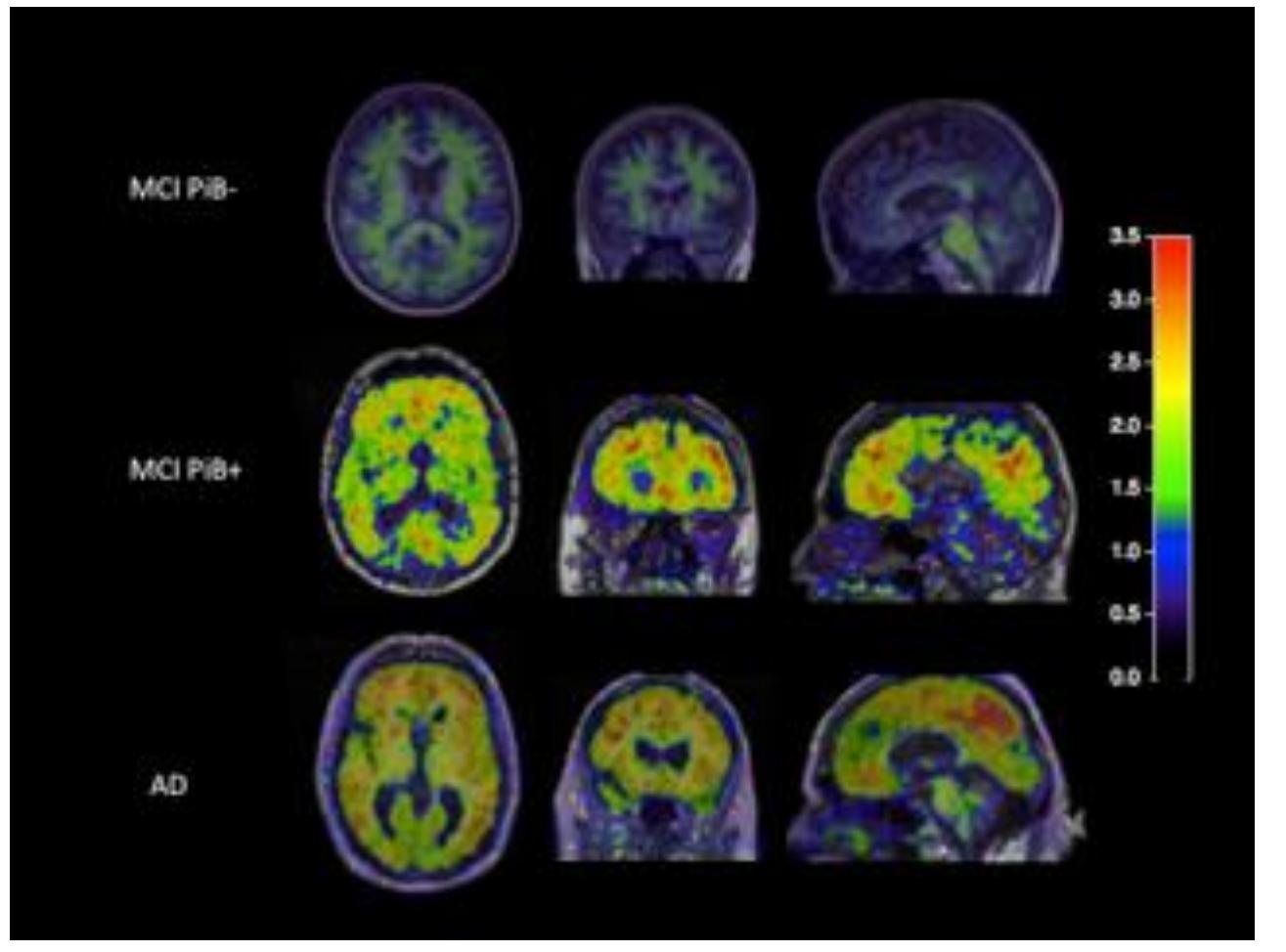 Fusion images from co-registered pet and mri scans.