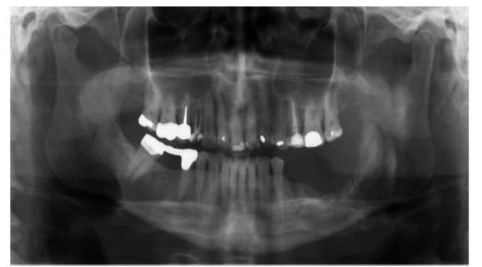 Panoramic radiograph showing osteolysis due to