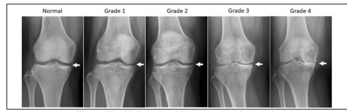 The kellgren and lawrence grading scale fig. 1 shows the