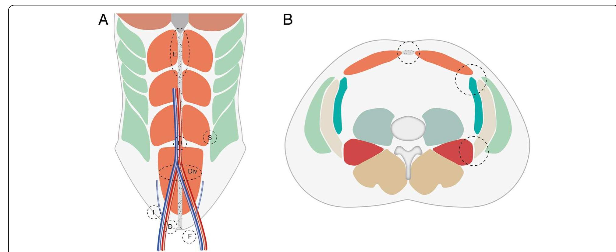 A schematic coronal drawing of the anterior abdominal wall
