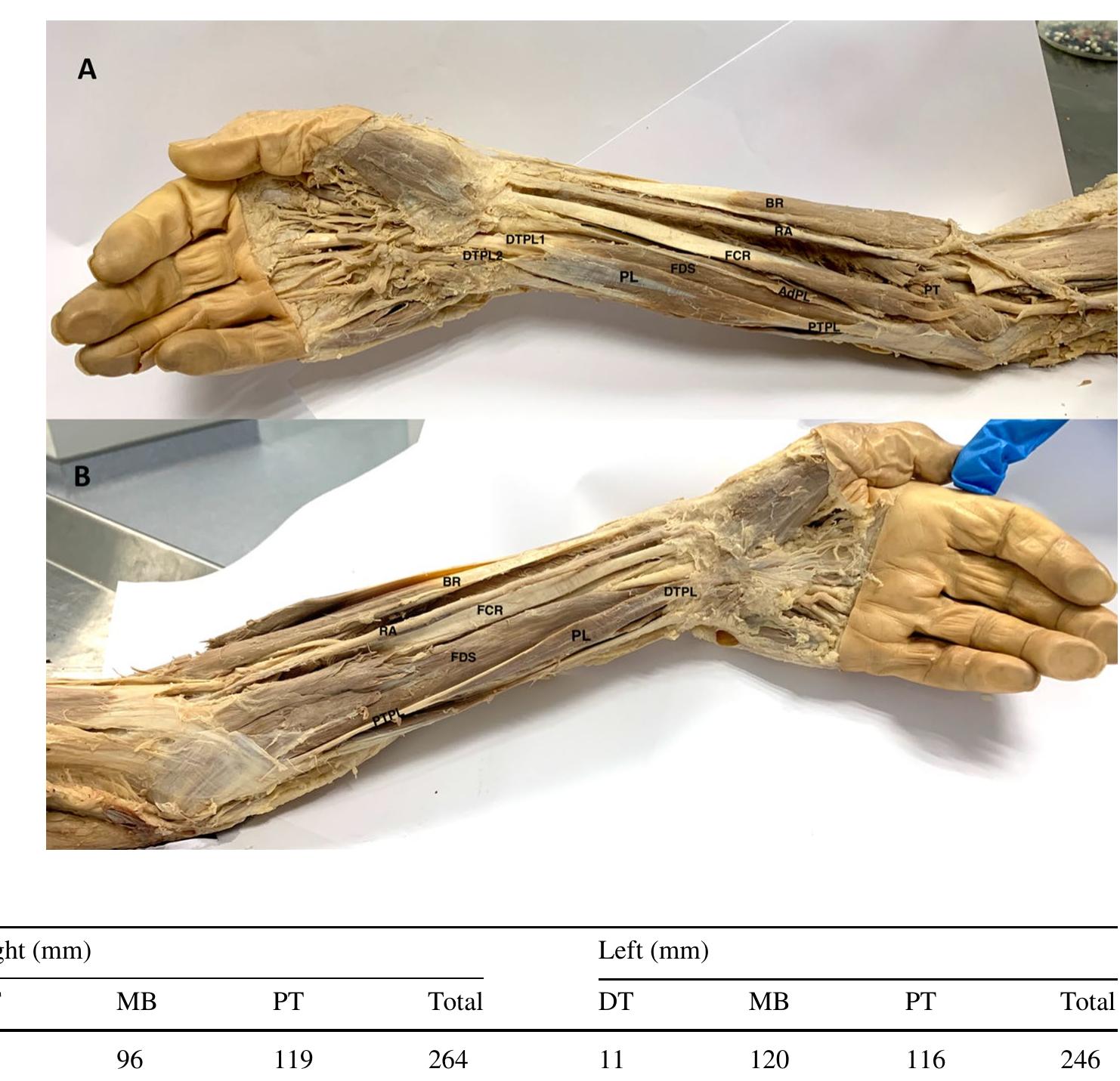 Dt distal tendon, mb muscle belly, pt proximal tendon digiti