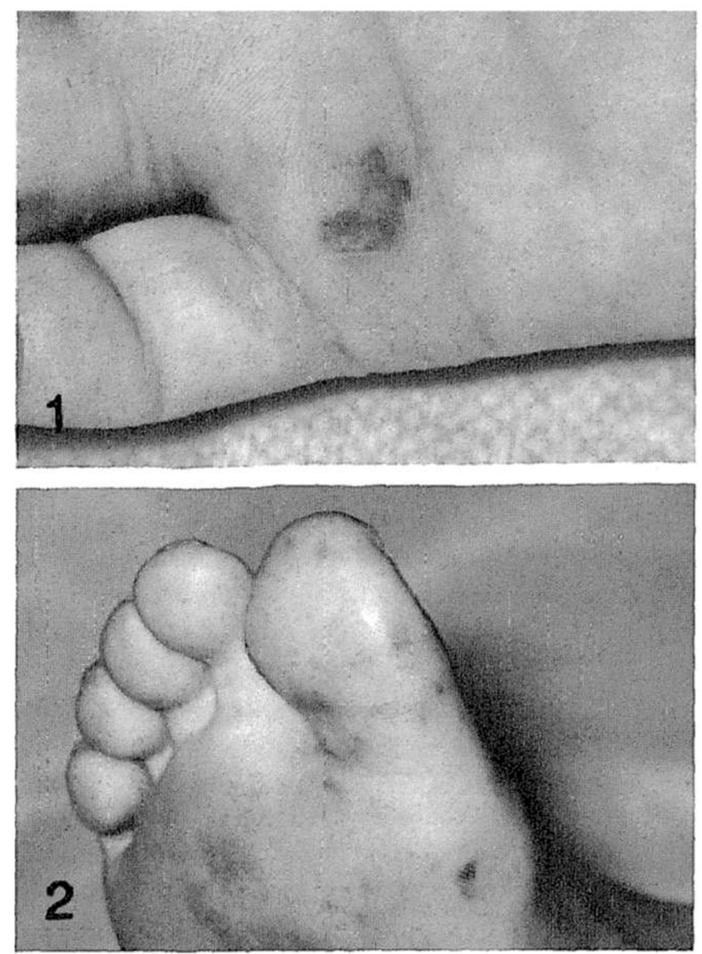 Janeway lesion on palm, fig. 2. multiple janeway lesions on