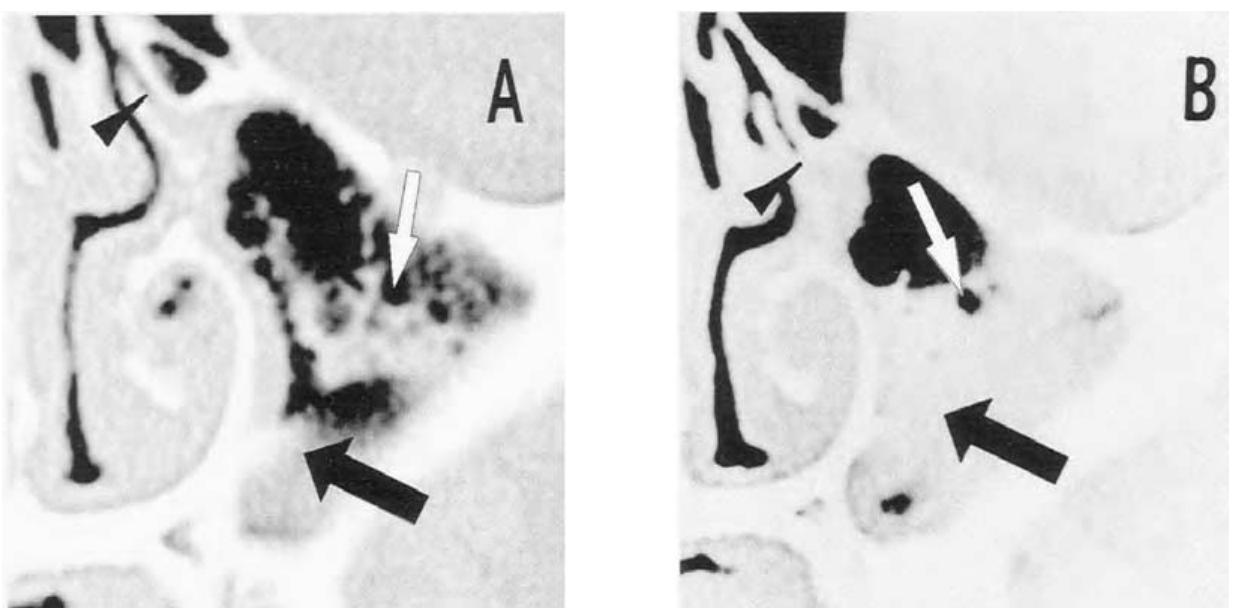 Coronal ct scan of the maxillary sinus of an adult with a