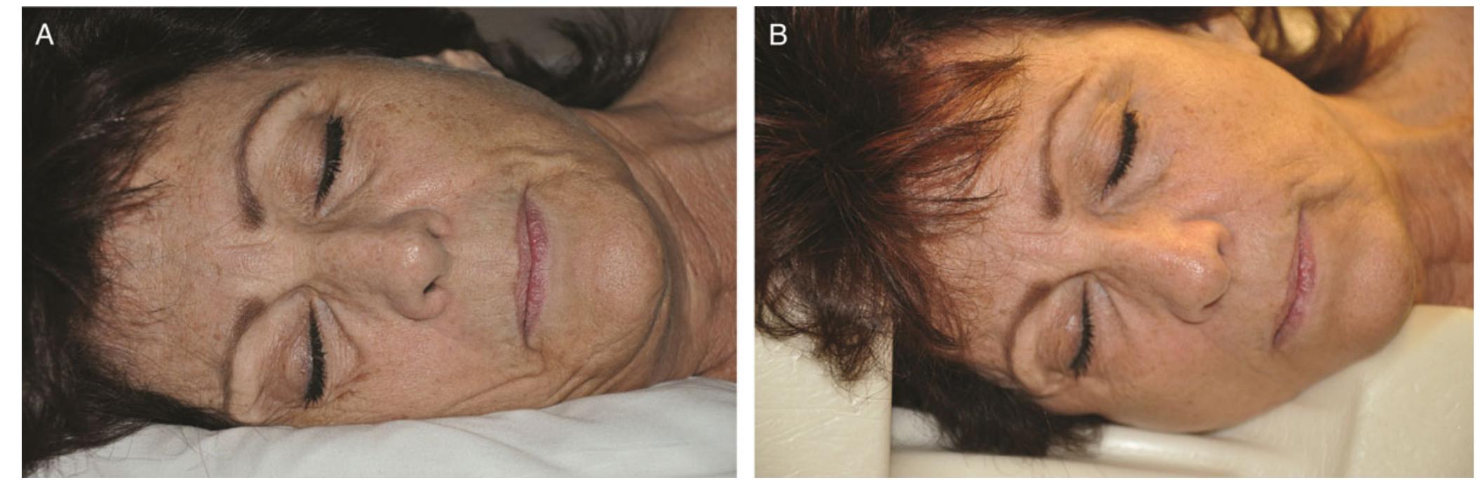 A 59-year-old woman demonstrating sleep wrinkles reinforced