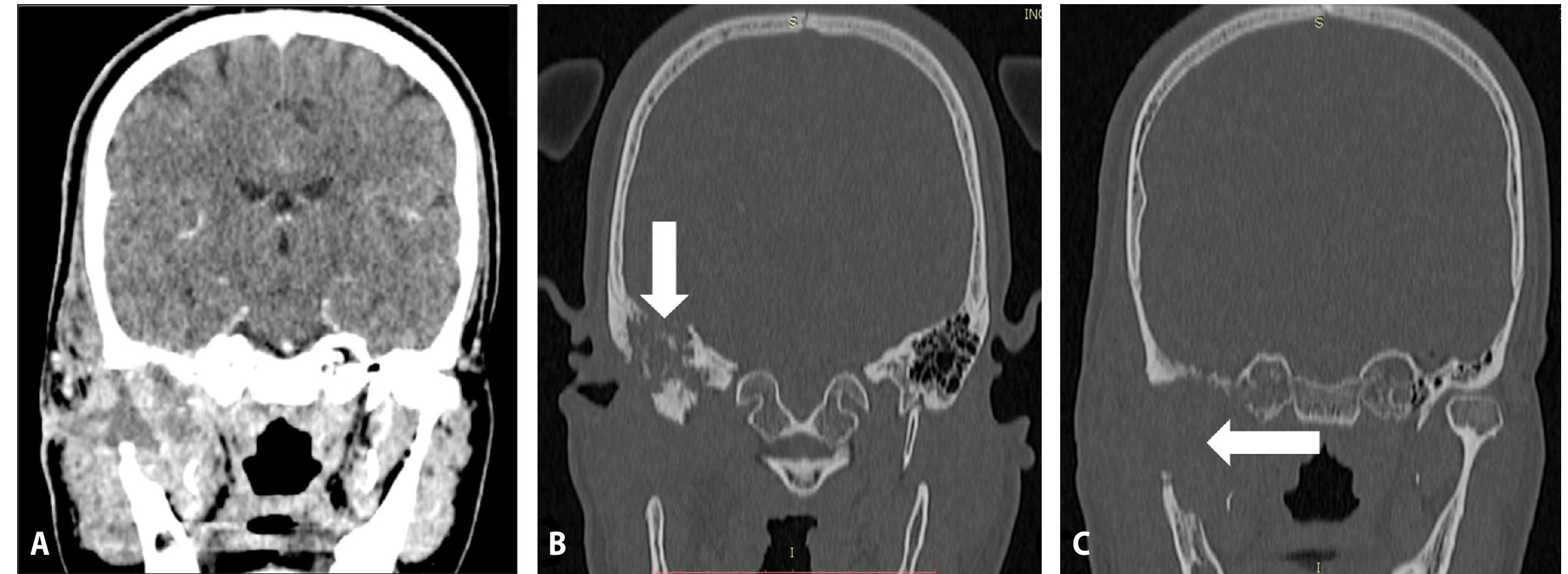 A. cranial and temporal contrast-enhanced ct scan, coronal