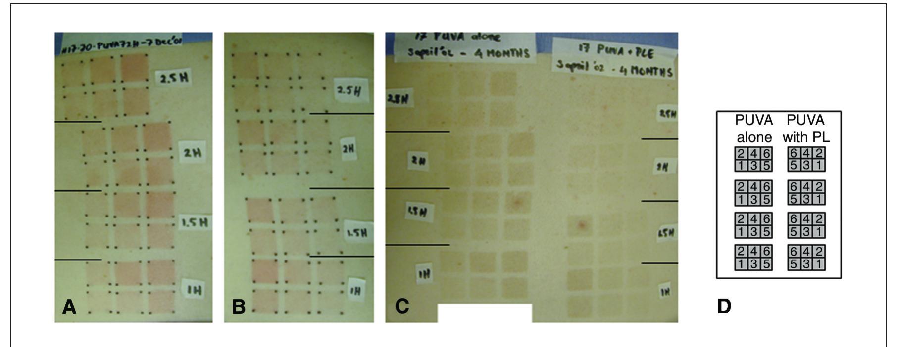 Pictures of one subject. a: phototoxic reaction 48 hours