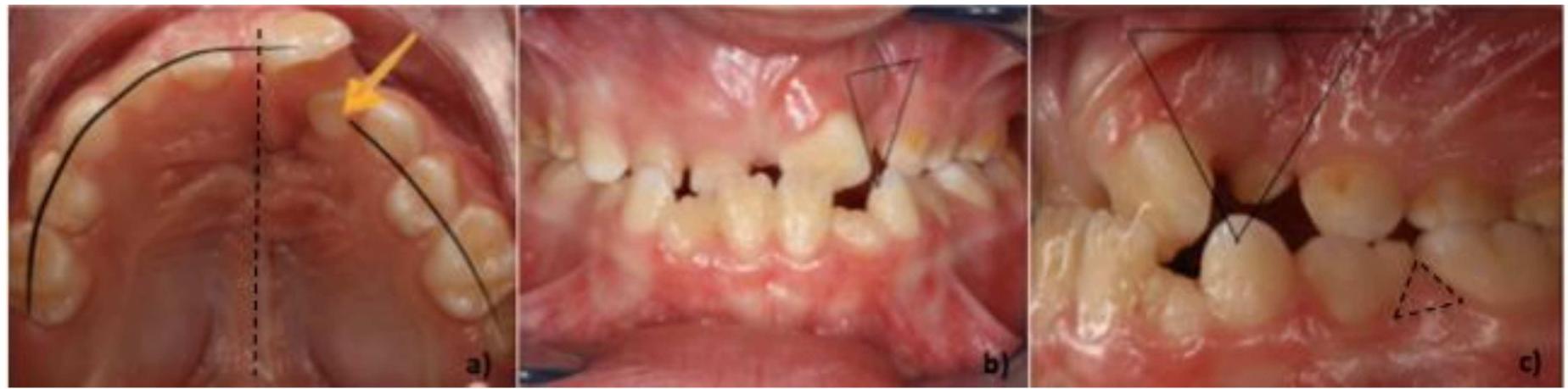 Intraoral photographs of a child with cleft lip and palate,