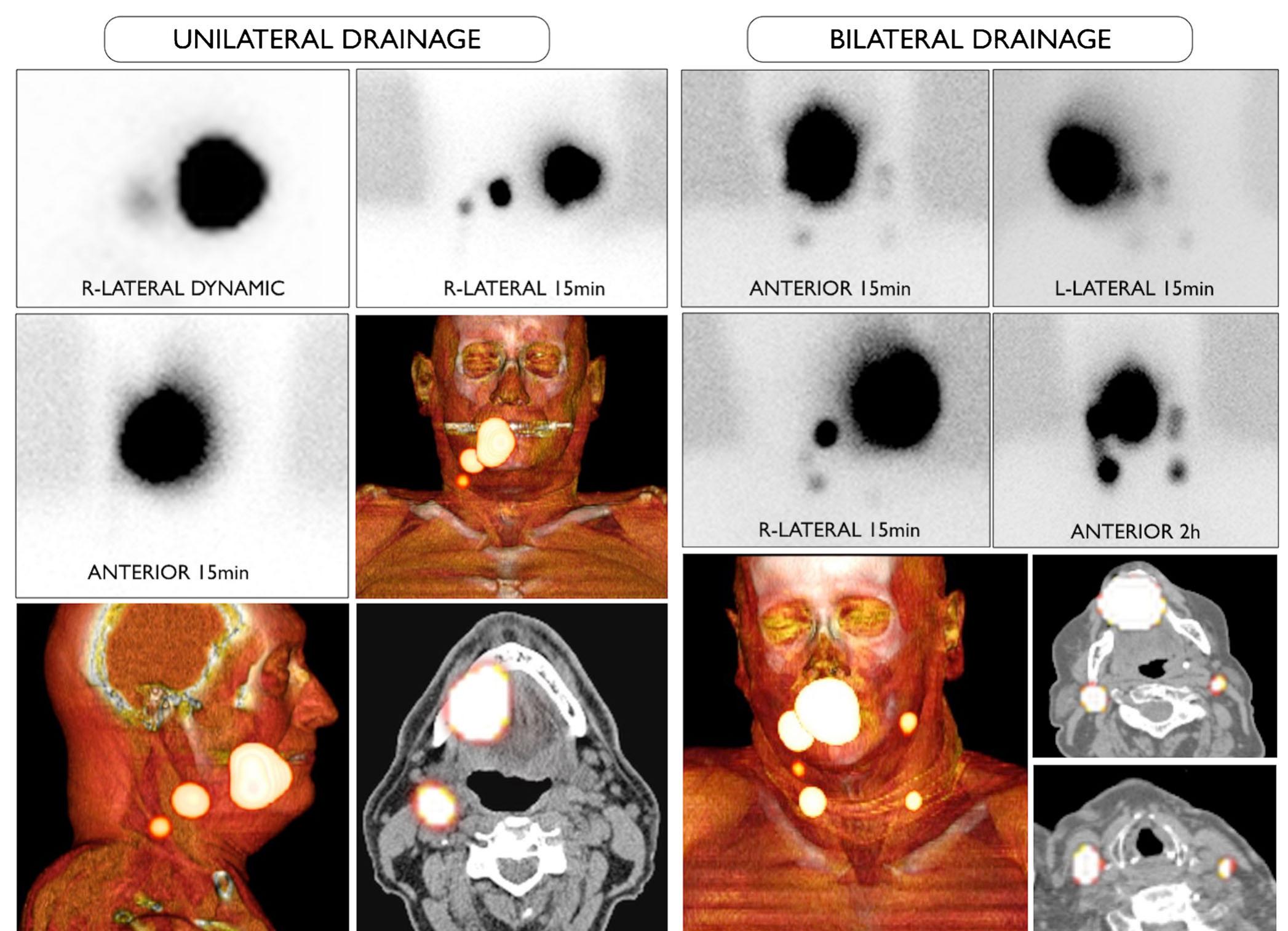 Sternocleidomastoid muscle, as depicted on volume rendering