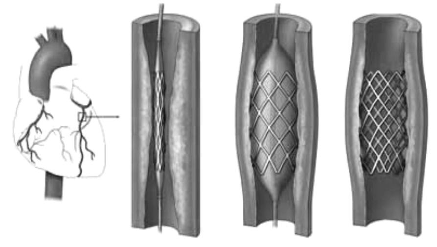 Steps of the coronary stent implant procedure for coronary