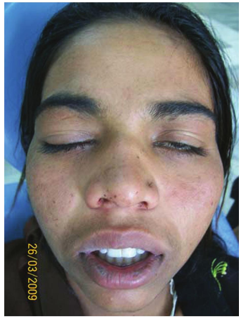 Orbital oedema on the right side. nasal myiasis is