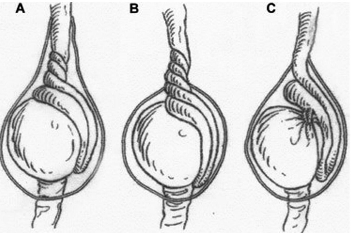 Classification of types of testicular torsion. (a)