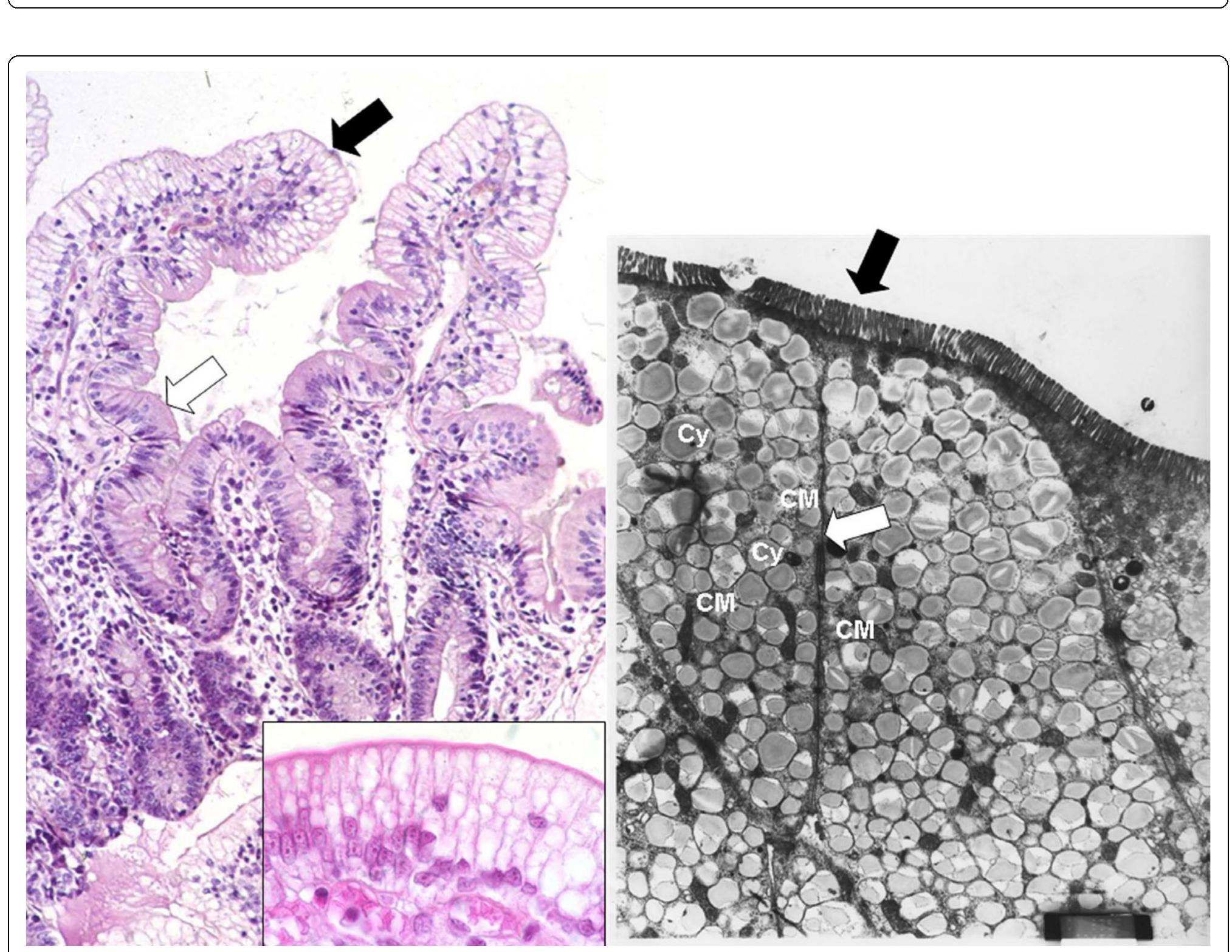 Histology of a jejunal biopsy from a crd patient. panel a: